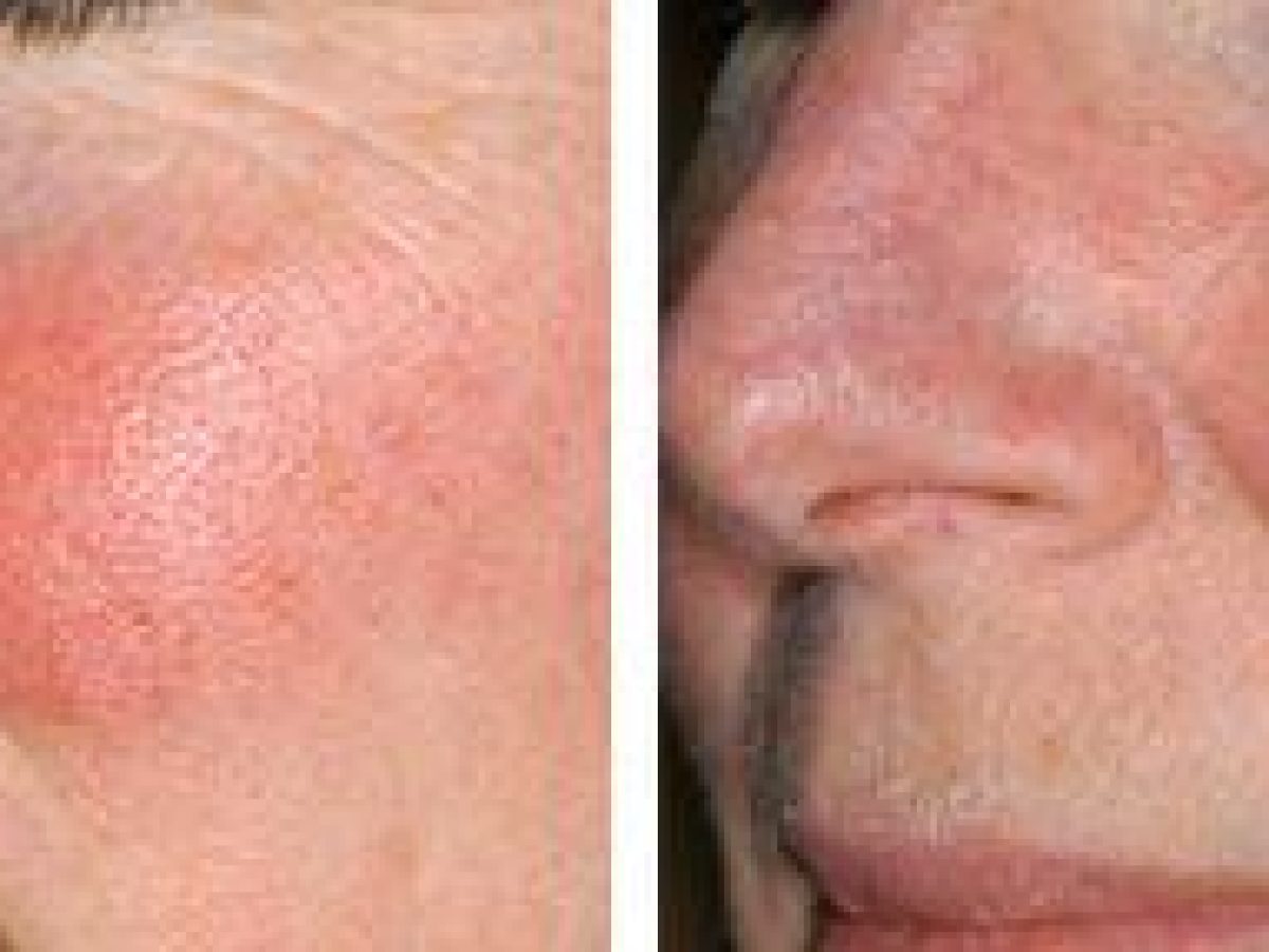 5 Effective Treatments for Skin Pigmentation at Aesthetic World Clinic ...